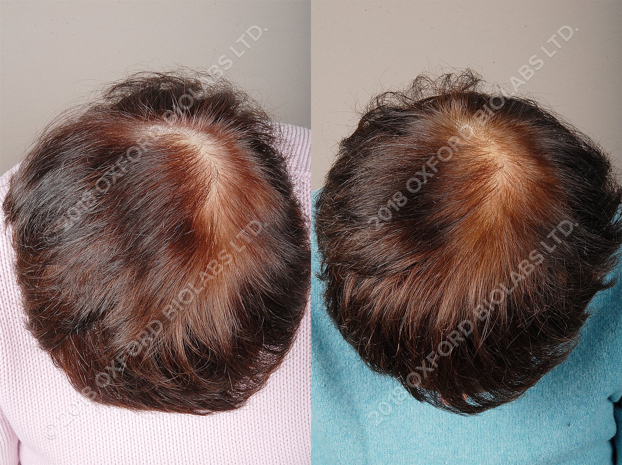 TRX2® Hair Revitalising Lotion - Oxford Biolabs